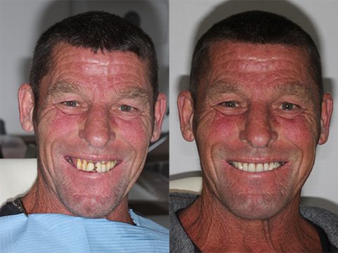 Dental Implants Windsor | Replace Missing Teeth In Windsor Smile Rooms