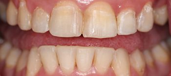 Narrow Arches - Smile Rooms