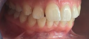 Overjet Teeth - Smile Rooms